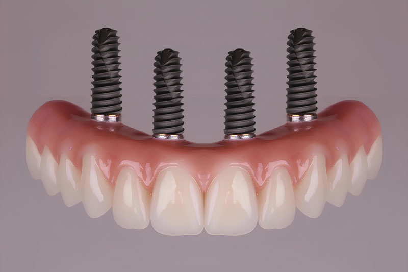 Enhancing Your Smile with All-on-4 Dental Implants in Portland, OR ... Enhancing Your Smile with All-on-4 Dental Implants in Portland, OR ...